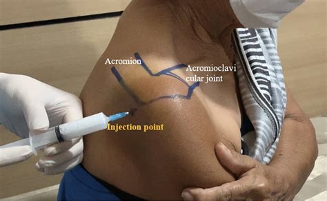 Landmark Of The Posterior Approach Of Subacromial Corticosteroid