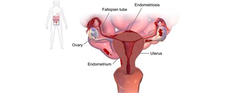 Endometriosis Insights Everything You Need To Know