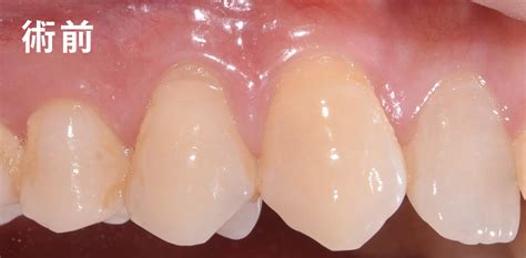 牙肉重建案例分享 Dr Implant 新竹光明牙醫診所