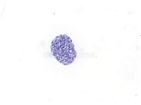 Bone Marrow Involvement By Disseminated Toxoplasmosis Cytology Stock