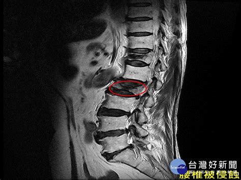 7旬翁腰酸背痛腎功能變差 竟是多發性骨髓瘤惹禍 台灣好新聞 Taiwanhot