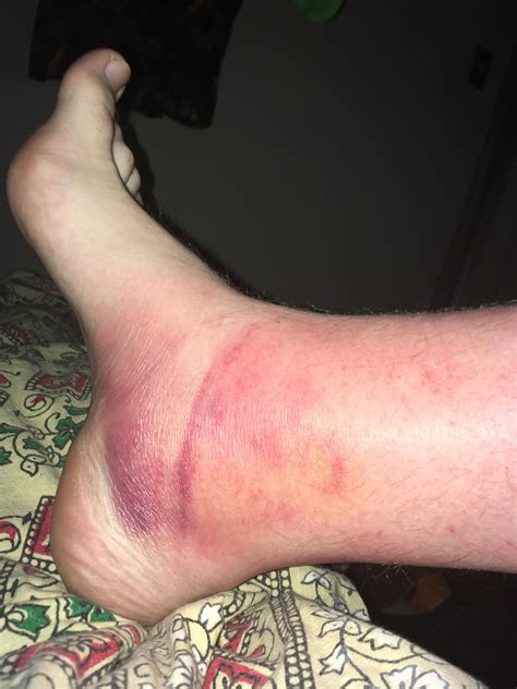 First Bite Syndrome Cure Holdenprimo