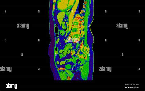 Abdominal Ct Scan Abdomen Hi Res Stock Photography And Images Alamy