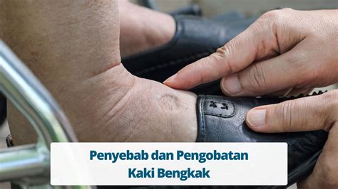 Kenali Penyebab Kaki Bengkak Primaya Hospital