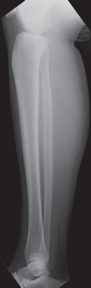 Female Tibia And Fibula Radiology Key
