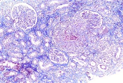 Renal Biopsy Light Microscopy On The Left Large Non Necrotizing