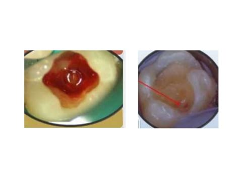 Direct And Indirect Pulp Capping Pptx Dental Health Diseases And Conditions