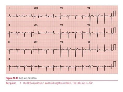 AXIS TYPES OF AXIS IN ECG AND HOW TO INTERPRET IN ECG PPTX