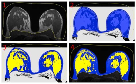 Steps Of Manual Breast Segmentation In Each Slice The User First
