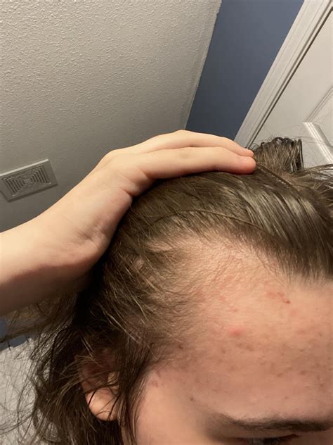 Heres A Little More Pictures Of My Hair Pretty Sure Im Balding At 15