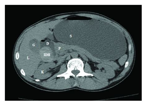 Axial Image Of Noncontrast Ct Scan Of The Abdomen At The Level Of Download Scientific Diagram