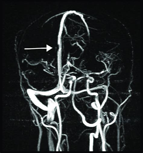 Initial Magnetic Resonance Venogram Of The Brain Showing A Right
