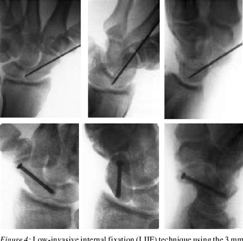 Figure 2 From Management Of Acute Scaphoid Fractures In Athletes