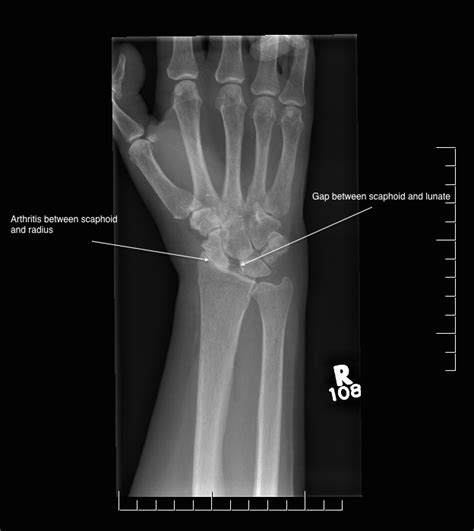Hands Arthritis Oxford Orthopaedics