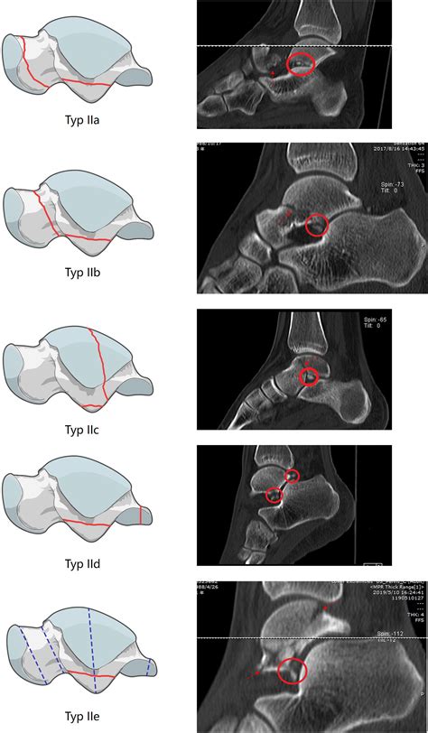 New Classification Based On Ct And Its Value Evaluation For Fractures Of The Lateral Process Of