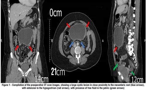Laparoscopic Management Of Acutely Symptomatic Chylous Mesenteric Cyst