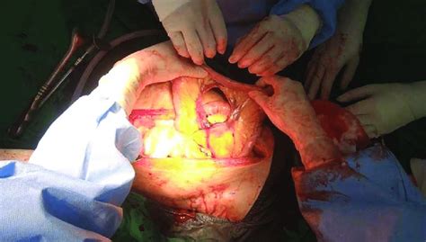 The Mesenteric Avulsion Of The Jejunum With Active Bleeding From The