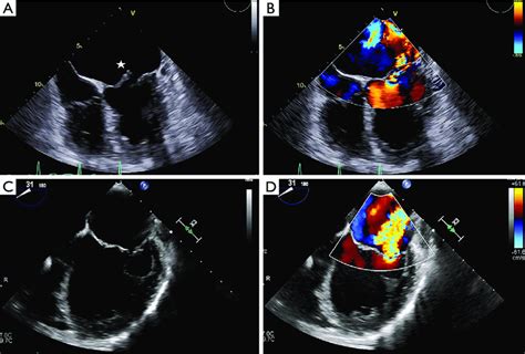 Pathophysiology Of Mitral Regurgitation Ascertaining The Download