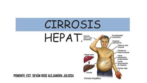 Cirrosis Hepática SevÁn Rios Alejandra Julissa Udocz