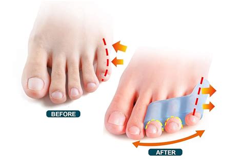 Little Toe Straightener A Simple Solution For Common Toe Deformities