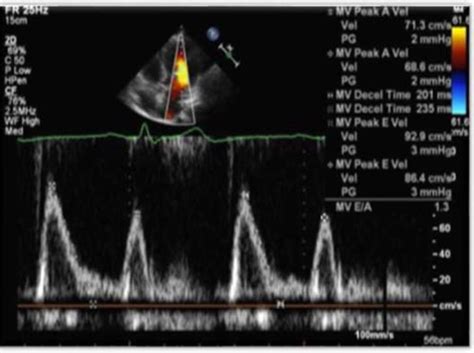 Diastolic Dysfunction Basics Flashcards Quizlet
