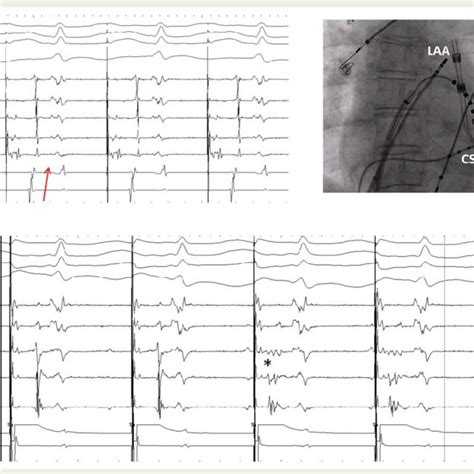 A Complete Mitral Isthmus Line Block Was Created Using A