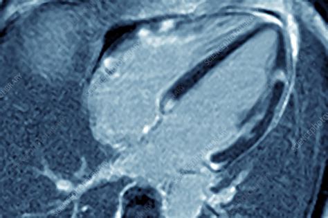 Cardiac Sarcoidosis Mri Scan Stock Image C0556104 Science Photo