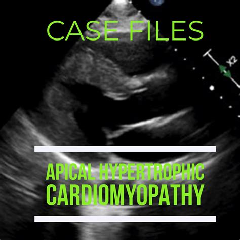 Case Files Apical Hypertrophic Cardiomyopathy — Usf Emergency Medicine