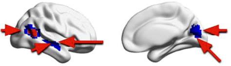 Depression Perception Myt1l Mice Brain Signal Variability The Transmitter Neuroscience News