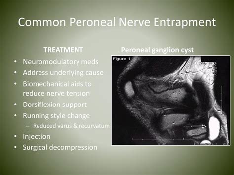 Ppt Nerve Entrapments In Runners Powerpoint Presentation Free