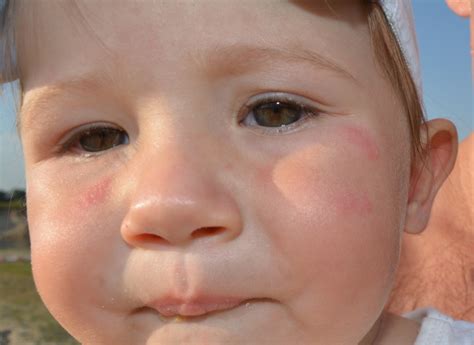 Красные пятна на лице Вопрос дерматологу 03 Онлайн