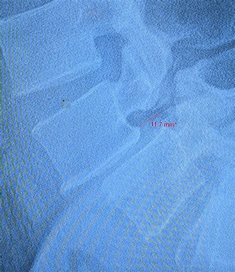 L4 L5 Alif First Surgery Down Rspinalfusion