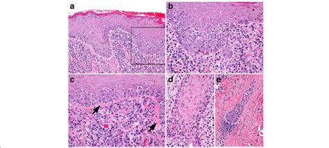 Histopathology Of Canine Mucocutaneous Lupus Erythematosus A
