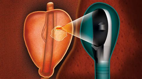 Focal High Intensity Focused Ultrasound Ablation For Intermediate Risk