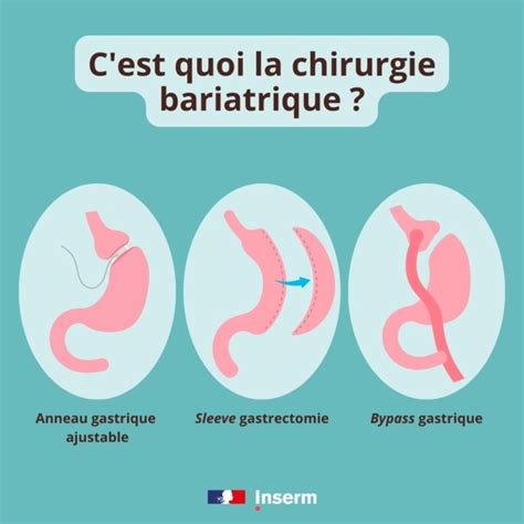 Protocole Chirurgie Bariatrique Obésité Lswe