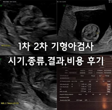 1차 2차 기형아검사 시기 종류 결과 비용 동탄제일병원 산부인과 후기 네이버 블로그
