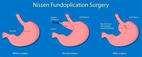 Reflux Surgery Dallas Mansfield And Plano Anti Reflux Surgery Dallas Fort Worth Tx