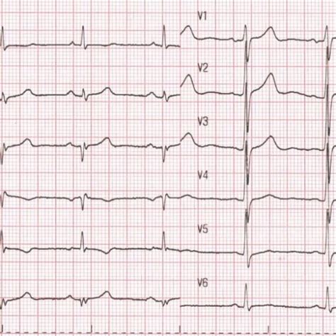ECG Demonstrating Abnormal Q Waves In Lead II And III As Well As T Wave Download Scientific