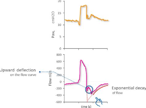 Figure 1 From Using Waveforms To Identify Asynchronies Step 2