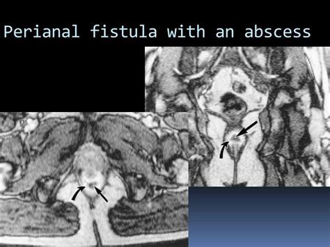 Ppt Mri Imaging Of Perianal Fistula Powerpoint Presentation Id2986971