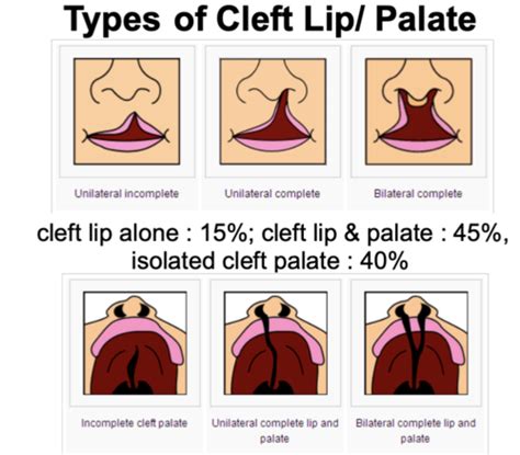 L11 Cleft Lip And Cleft Palate Flashcards Quizlet