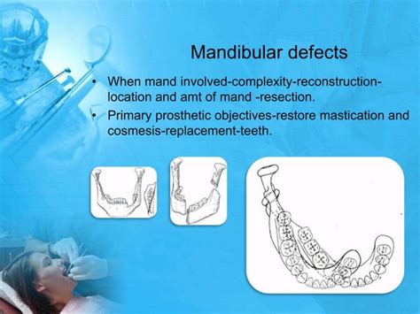Removal Partial Denture Considerationsin Maxillofacial Prosthetics Pptx