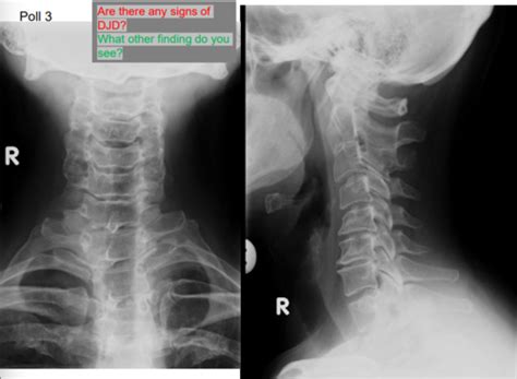 W7 And W8 Cervical And Lumbar Stenosis Flashcards Quizlet