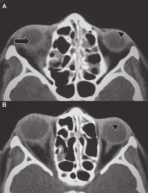 Post Septal Cellulitis Patient With Acute Sinusitis And Right