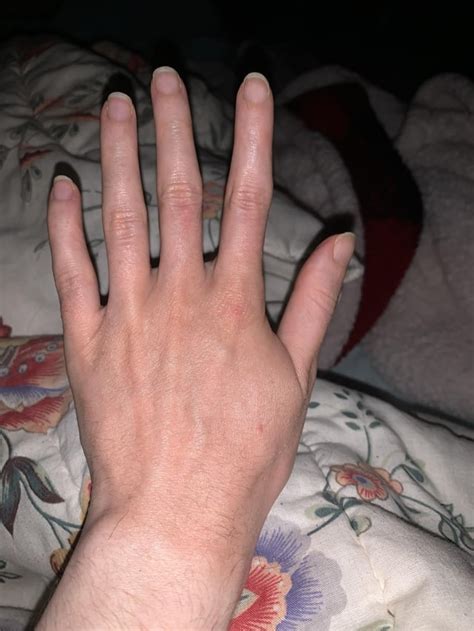 Over Washed Handsitchy Red Bumps Rskincareaddiction