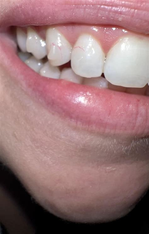 Anyone Know How I Can Treat This Weird Staining On My Attachments R