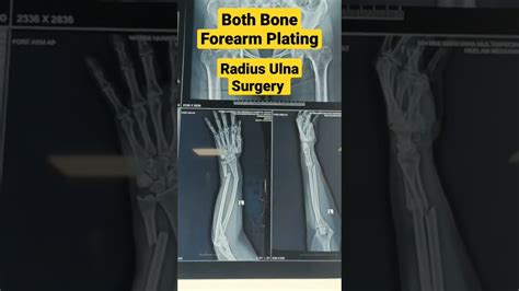 Forearm Radius Ulna Plating Surgery Doctor Shortsfeed Short Youtube