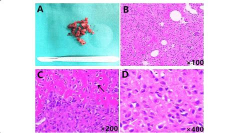 Histological Appearance Of The Tumor B C D Hande A The Gross