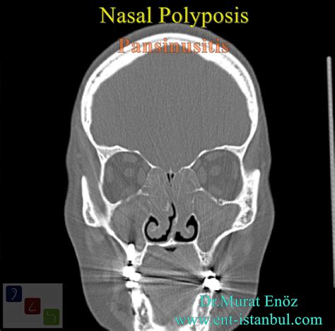 Nasal Polyp Definition Symptoms Diagnosis And Treatment