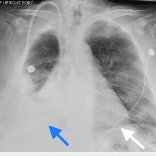 Chest Radiograph Posterior Anterior View Shows Multiple Nodu